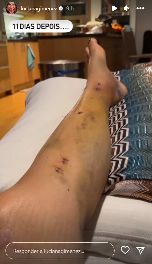 Luciana Gimenez choca ao mostrar sua perna com hematomas após cirurgia ...